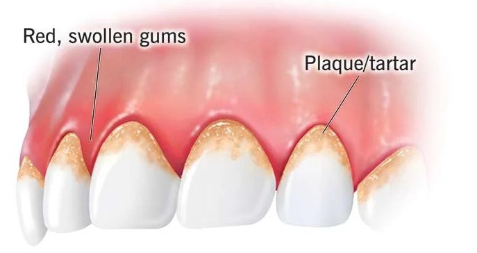 Healthy Gums – St Oswald's Dental